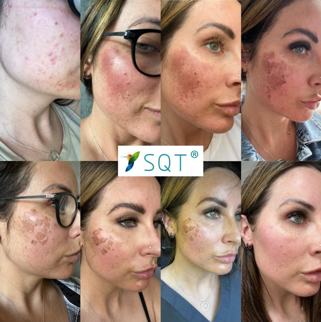 SQT Bio Microneedling | Thyme Laser & Beauty Corsham Bath